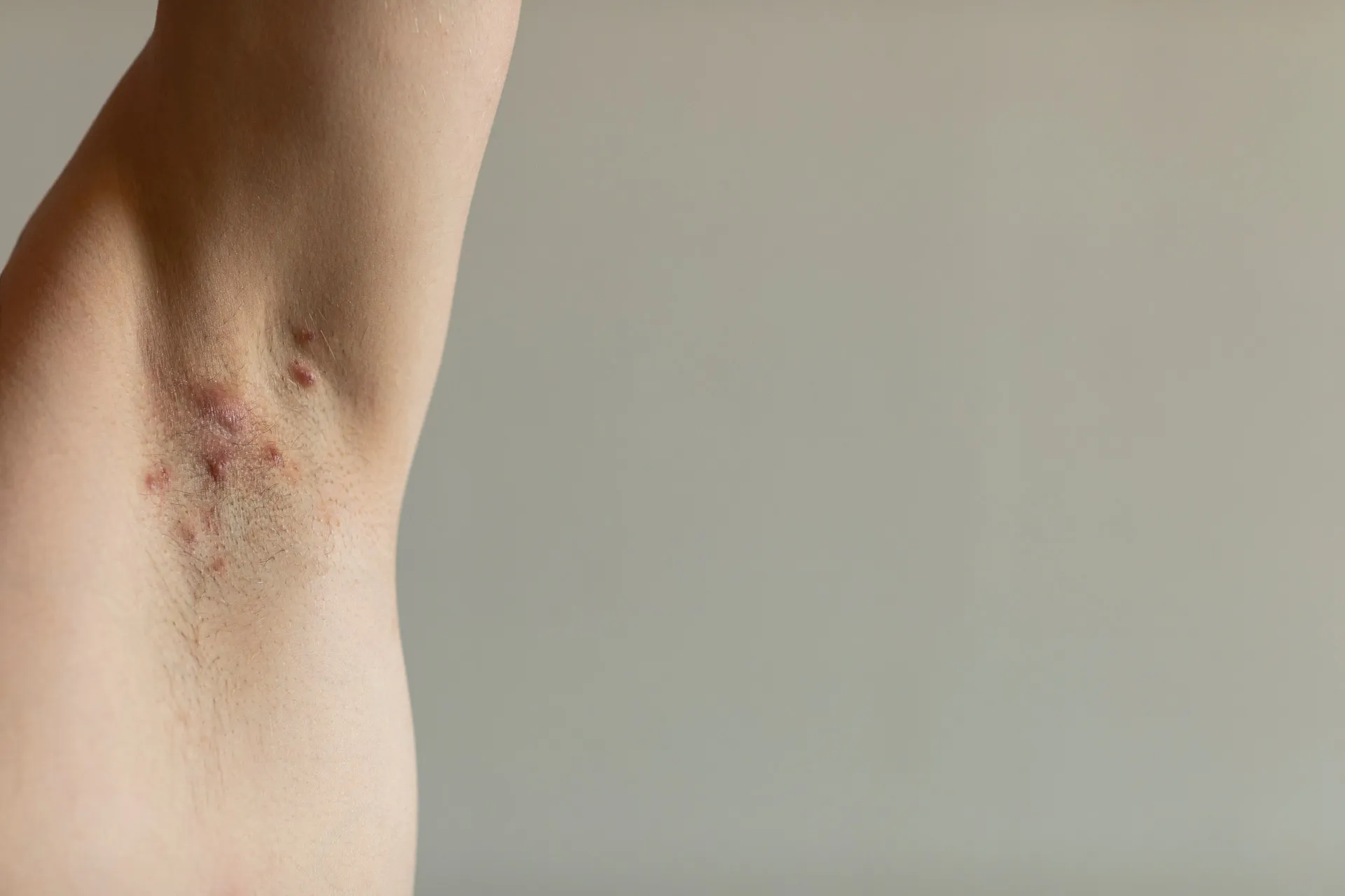 Laserontharing bij huidaandoeningen met ontstoken haarzakjes | Laserkliniek