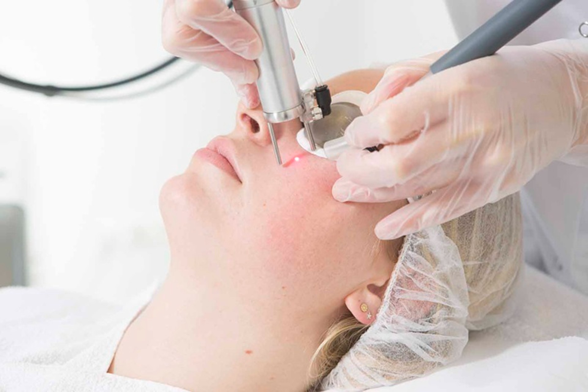 Wat is couperose precies? | Laserkliniek