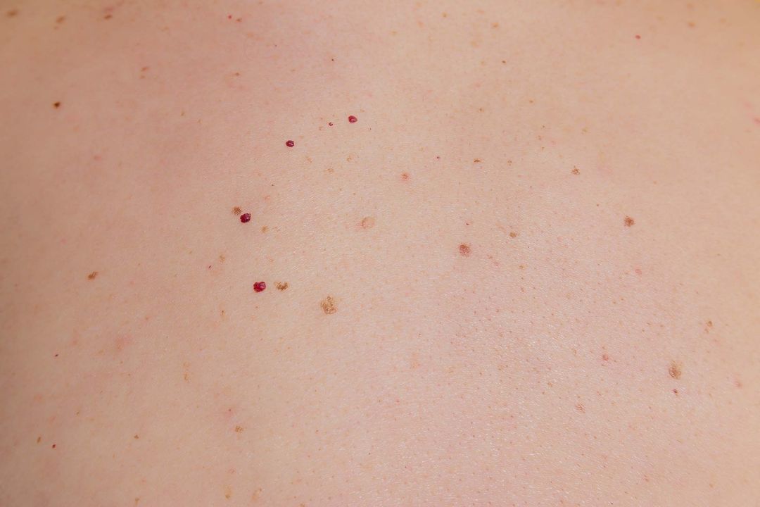 Bloedblaasje (angioma's/venous lake) | Laserkliniek