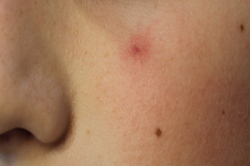 Wat is spider naevus? | Laserkliniek