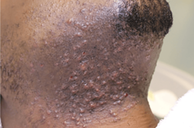 Folliculitis barbae omschrijving | Laserkliniek