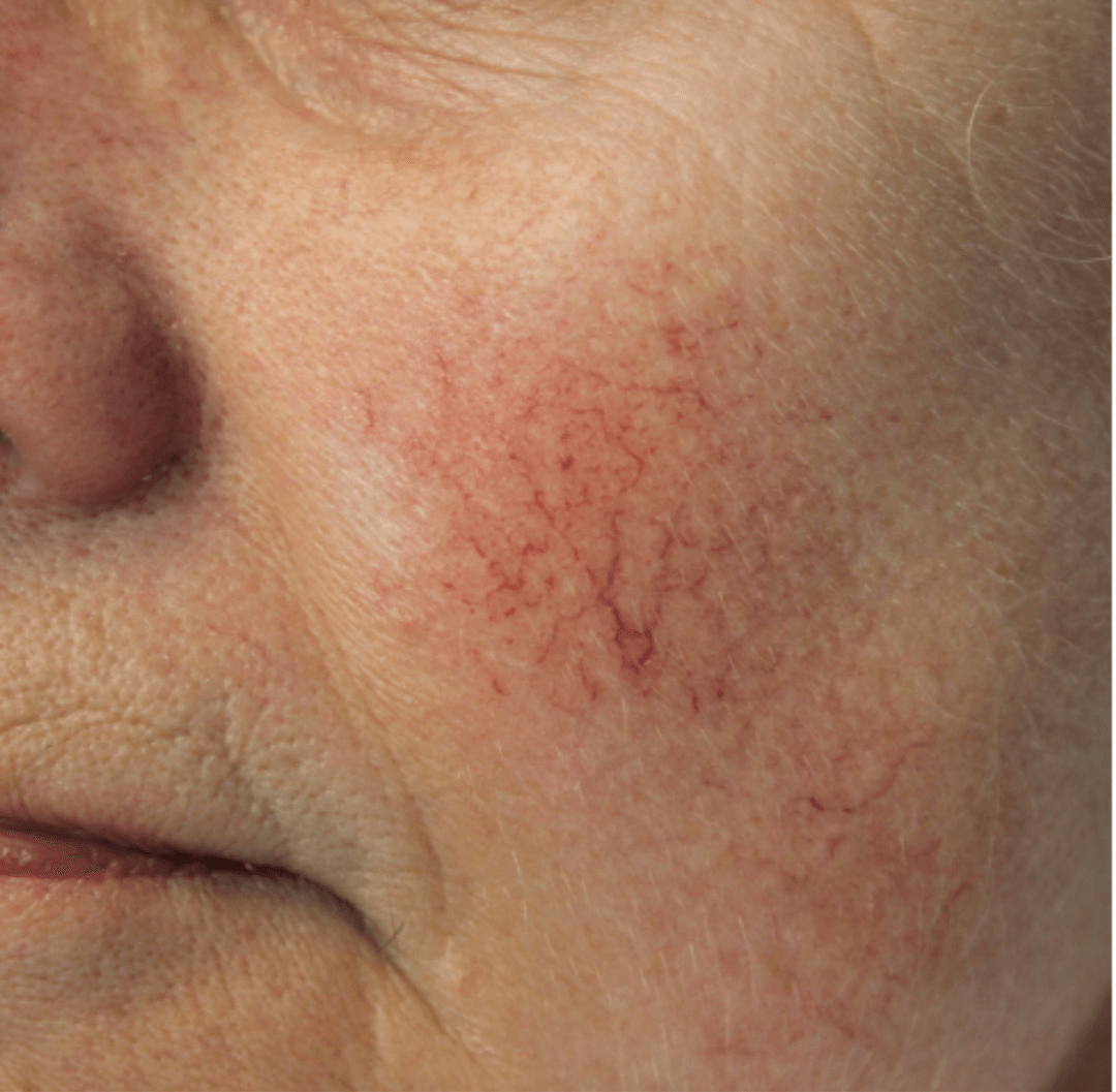 Wat is couperose precies? | Laserkliniek