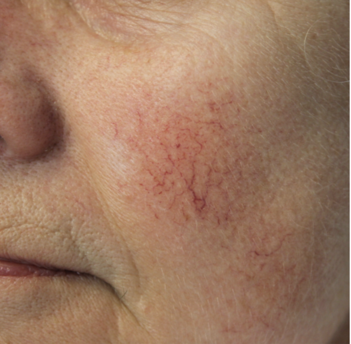 Vaatlaser behandeling bij couperose | Laserkliniek