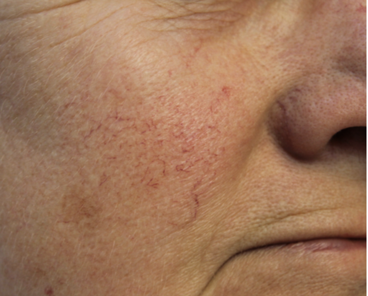 Wat is couperose precies? | Laserkliniek