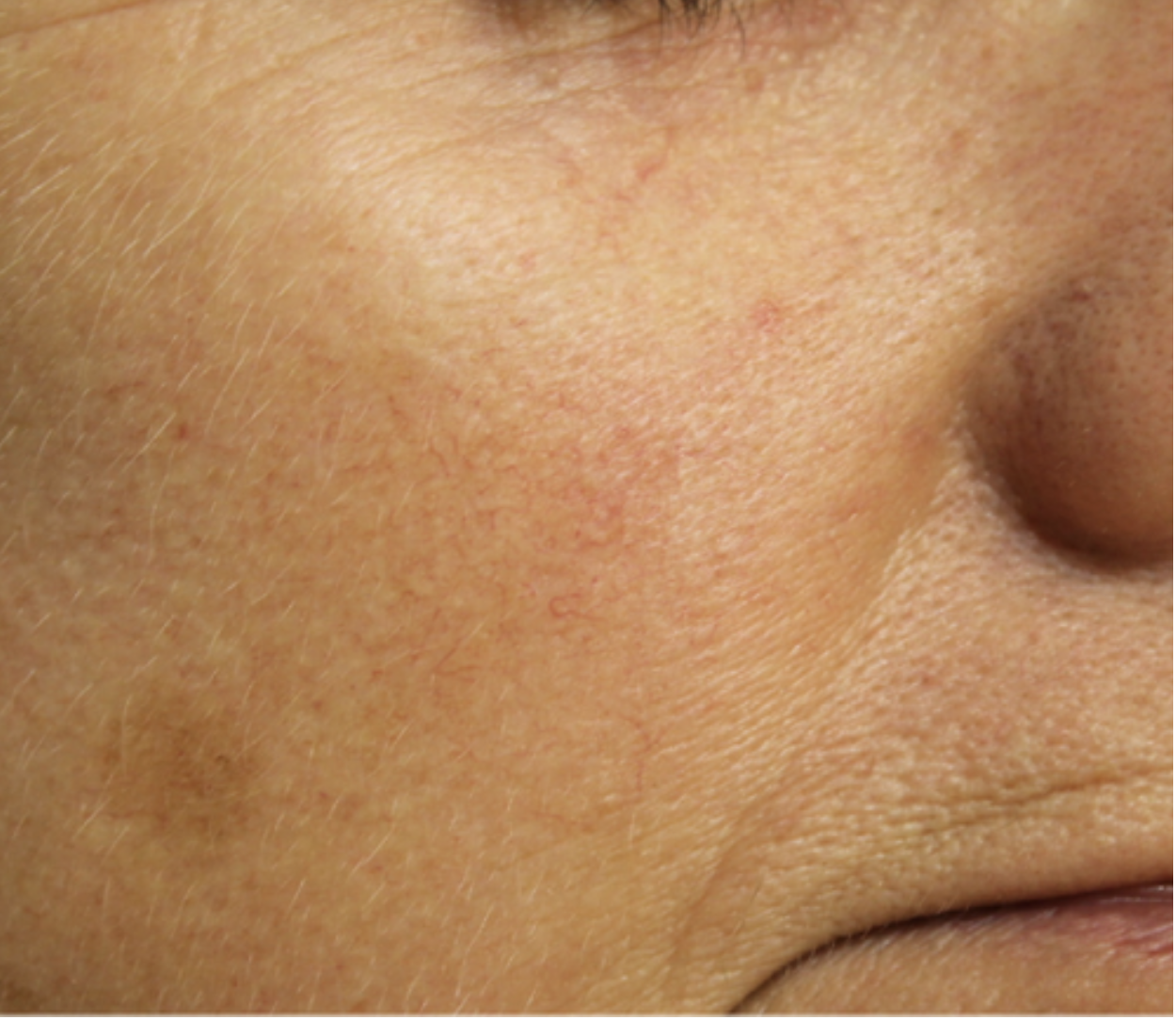 Wat is couperose precies? | Laserkliniek