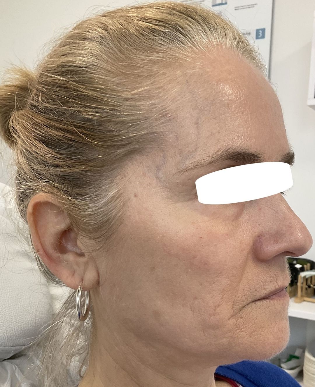 Behandeling met Cosmo peel Forte