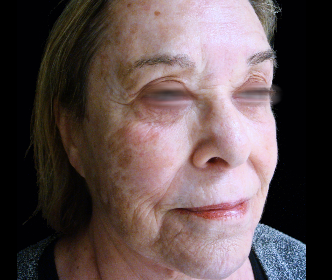 Before & After Photos Brown Spot & Discoloration Removal | NYC