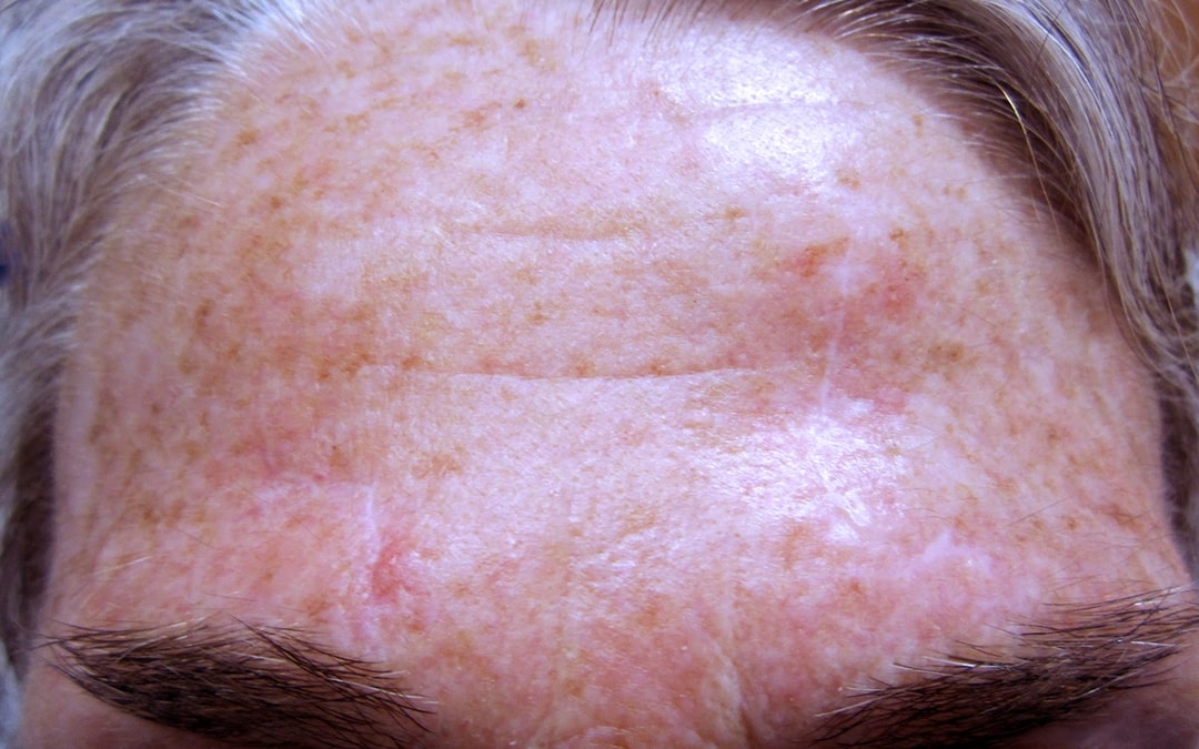 Before & After Photos Mohs Surgery Forehead 4 | NYC