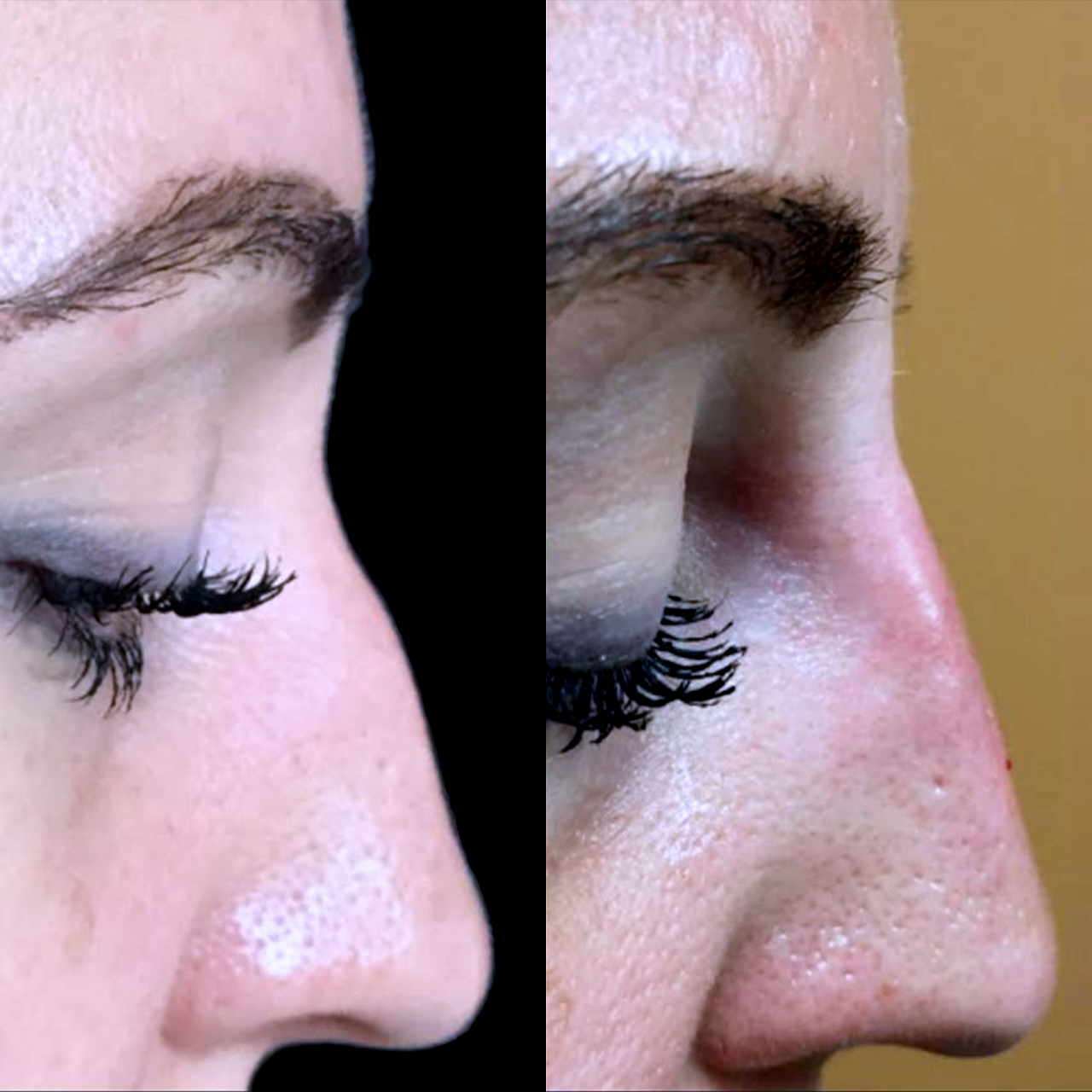 Before & After Photos Nose Reshaping 4 | NYC