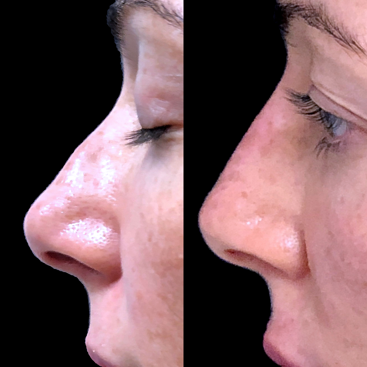 Before & After Photos Nose Reshaping 4 | NYC
