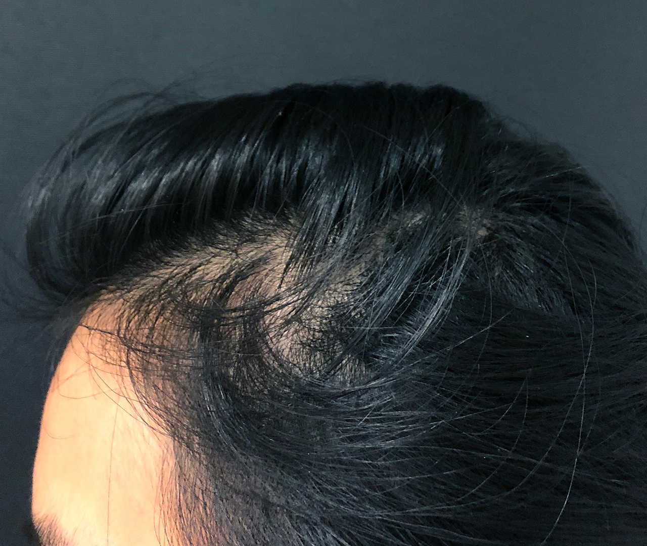 Before & After Photos Hair Restoration | NYC