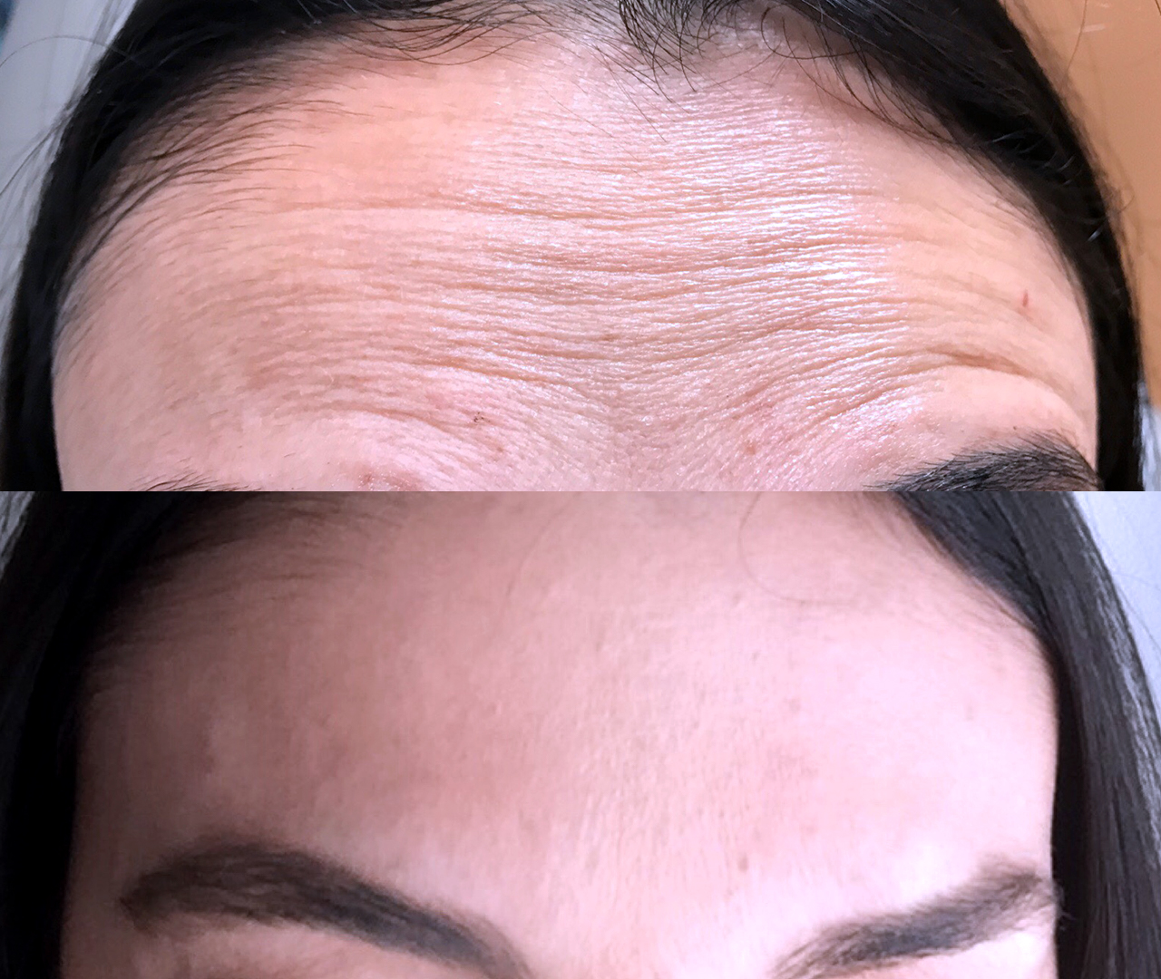 Before & After Photos Wrinkle & Line Reduction | NYC