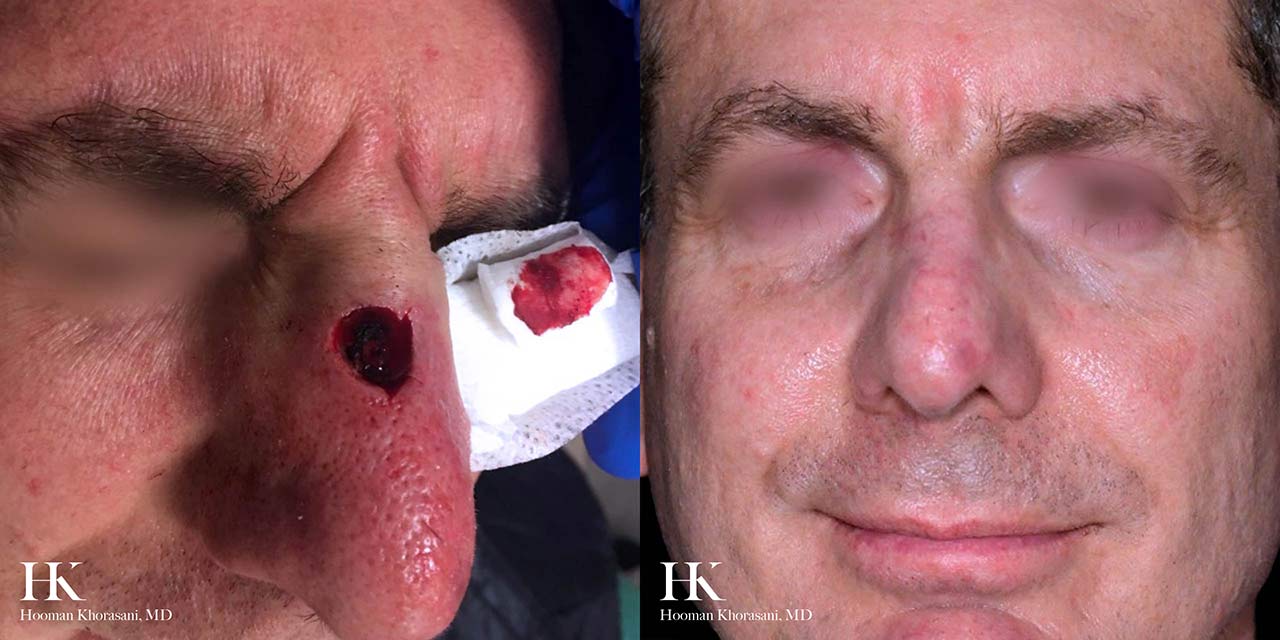 Before & After Photos Mohs Micrographic Surgery & Reconstruction ...