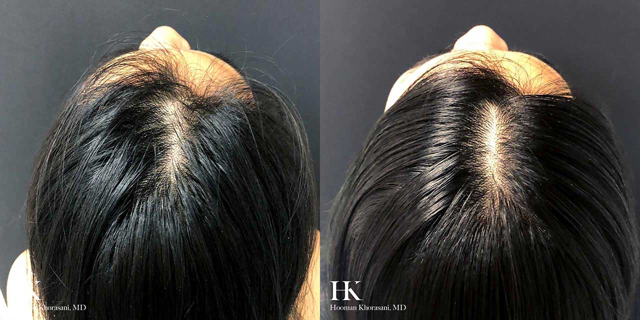 Before & After Photos Hair Restoration (Non-Surgical) | Cosmetic ...