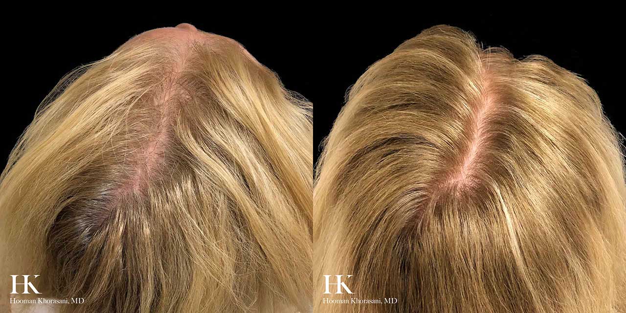 Before & After Photos Hair Restoration (Non-Surgical) | Cosmetic ...