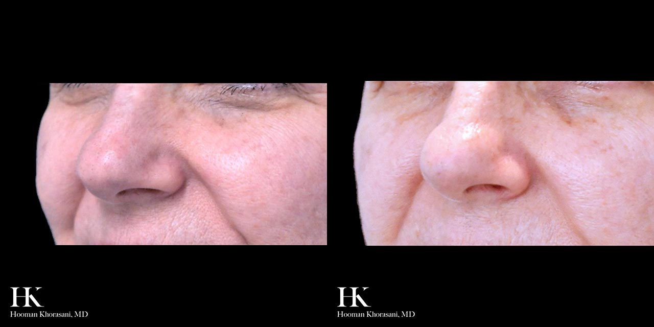 Before & After Photos Skin Tightening - RF Microneedling 2 | Cosmetic ...