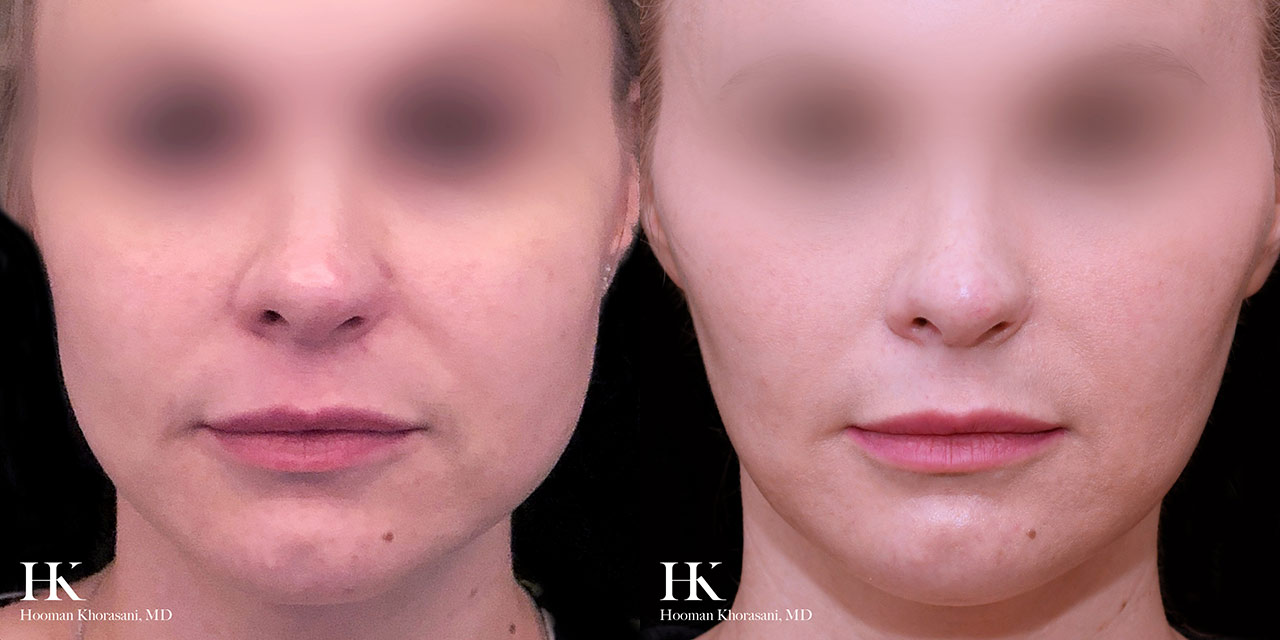 Before & After Photos Cheek & Jaw Contouring | Cosmetic Surgeon NYC