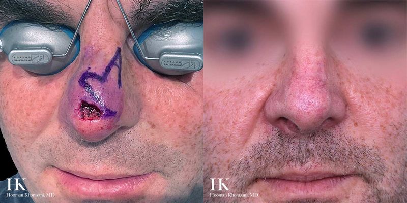 Before & After Photos Mohs Micrographic Surgery & Reconstruction ...