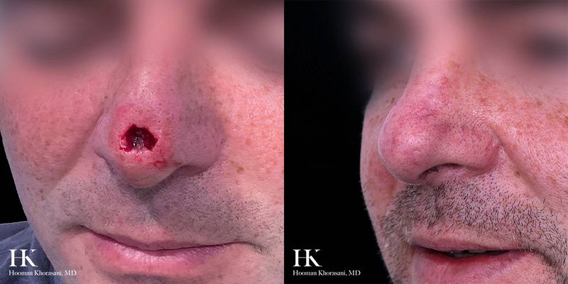 Before & After Photos Mohs Micrographic Surgery & Reconstruction ...
