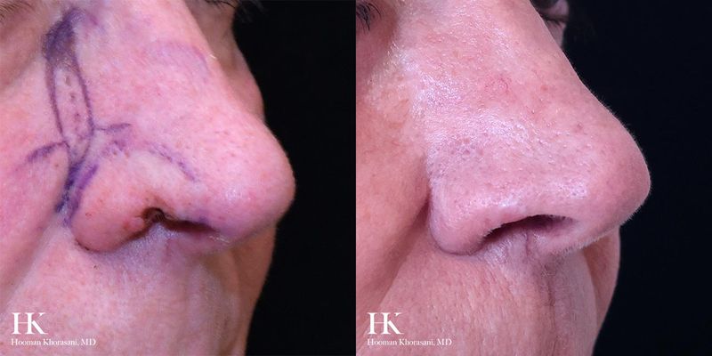 Before & After Photos Mohs Micrographic Surgery & Reconstruction ...