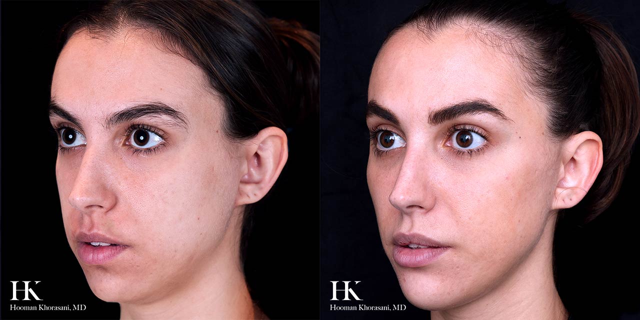 Before & After Photos Face Contouring (Fillers) | Cosmetic Surgeon NYC