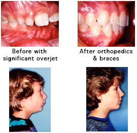 Early Treatment (Ages 4-10) | Busch & Musich Orthodontics