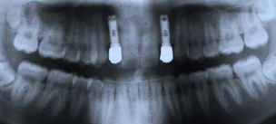 Congenital Absence of Teeth | Busch & Musich Orthodontics
