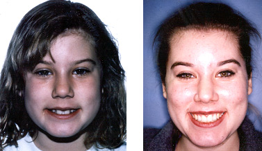 Congenital Absence of Teeth | Busch & Musich Orthodontics
