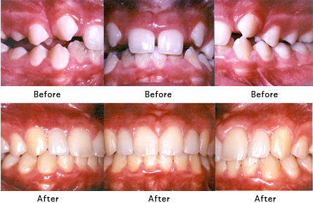 Congenital Absence of Teeth | Busch & Musich Orthodontics