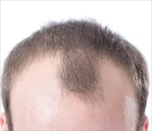 Hair Loss Treatment for Men | Find out How to Stop Hair Loss