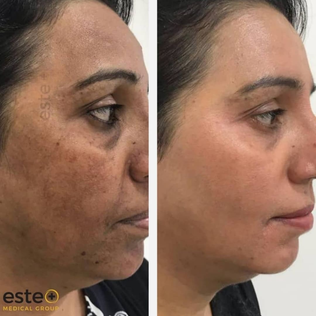 Skin Pigmentation Treatment | Laser Pigmentation | Cosmelan Peel
