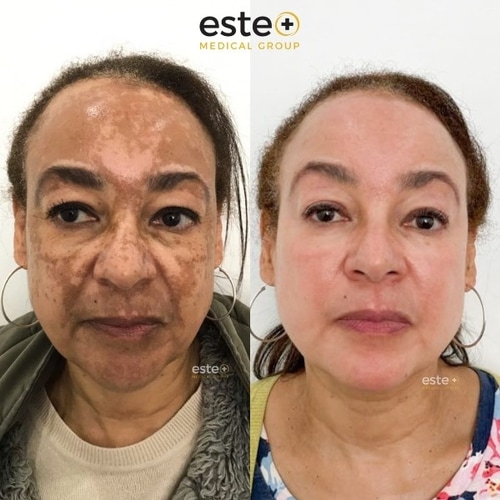 Skin Pigmentation Treatment | Laser Pigmentation | Cosmelan Peel