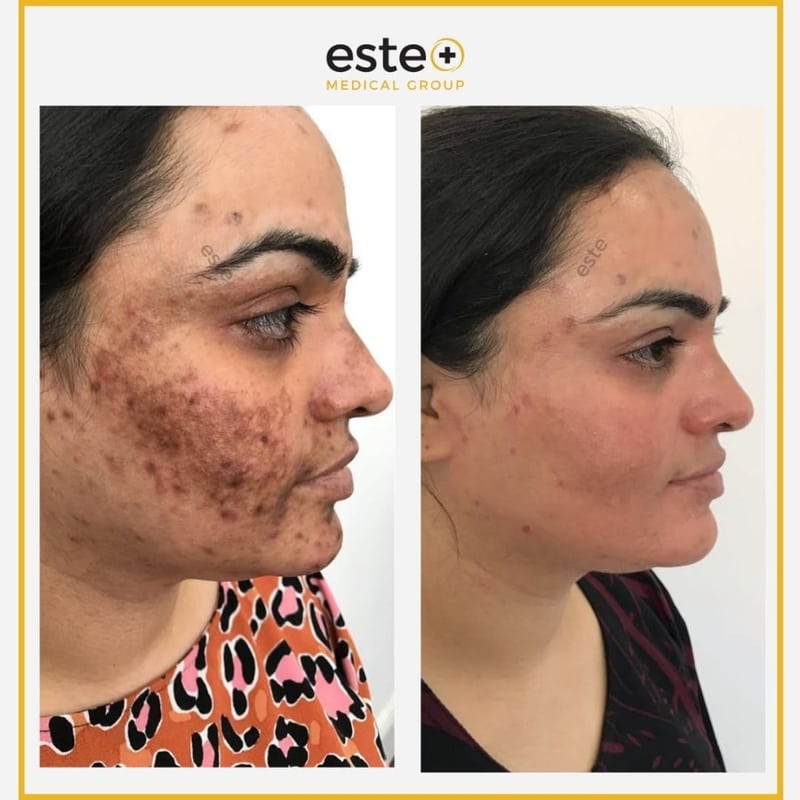 Cosmelan Pigmentation Peel | Este Medical Group