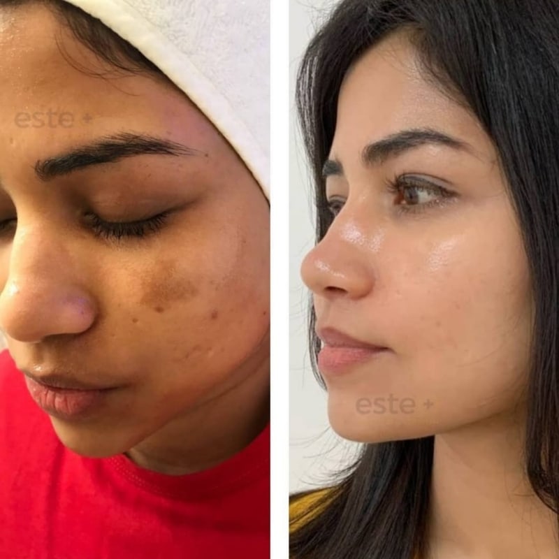 Cosmelan Pigmentation Peel | Este Medical Group