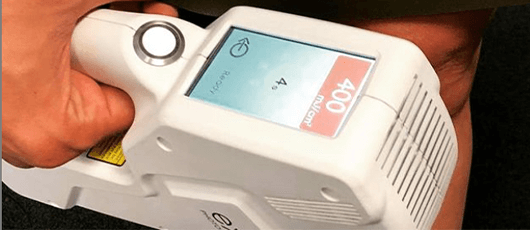 Exciplex Excimer Light Therapy | Vitiligo Treatment - Este