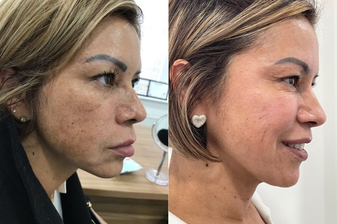 Cosmelan Pigmentation Peel | Este Medical Group