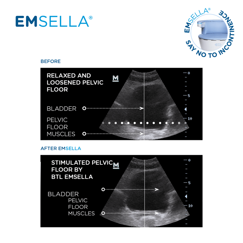Emsella | Pelvic Floor Treatment for Urinary Incontinence