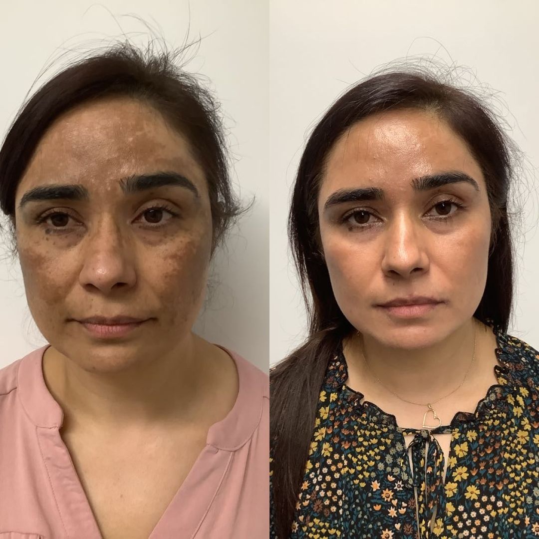 Cosmelan Pigmentation Peel | Este Medical Group
