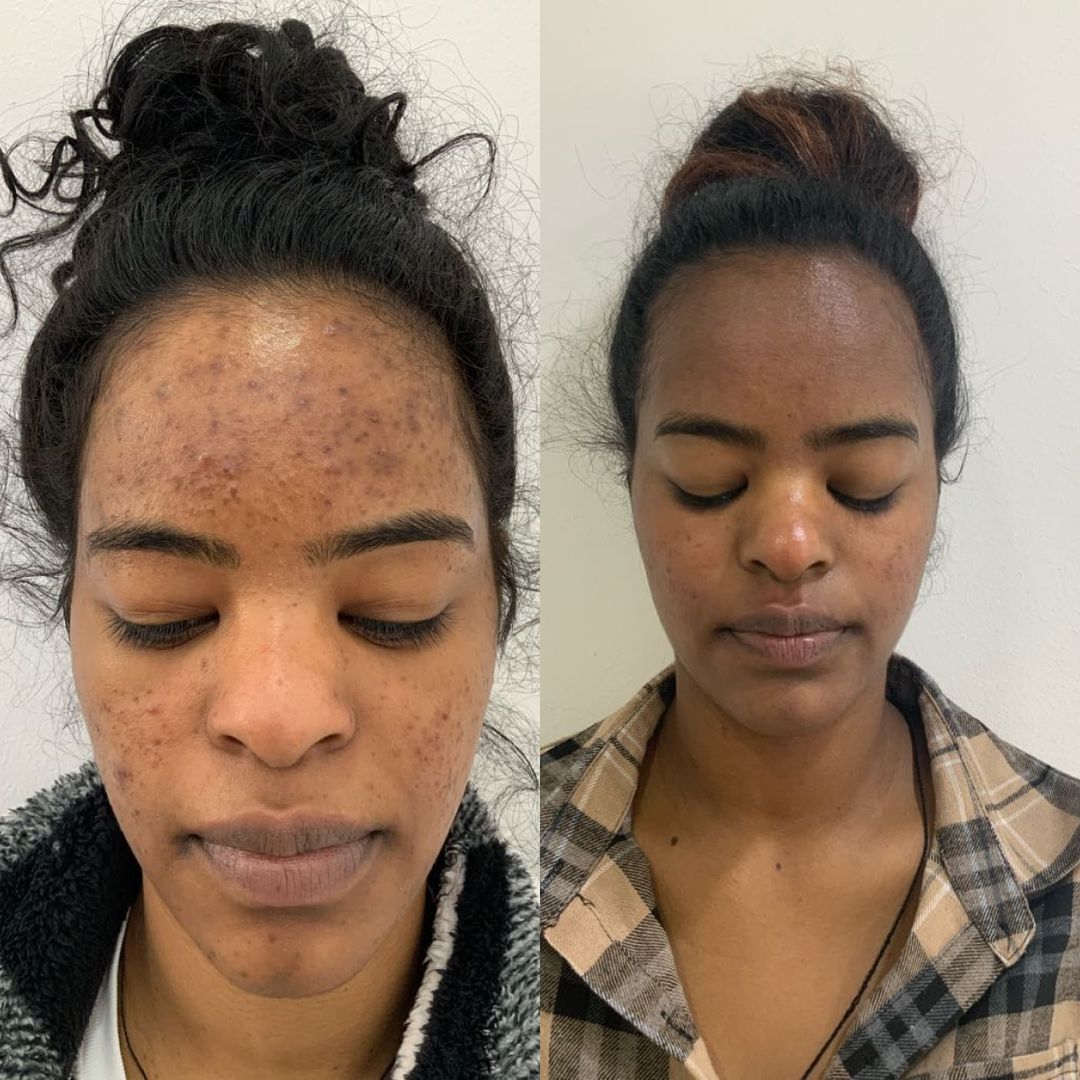 Cosmelan Pigmentation Peel | Este Medical Group
