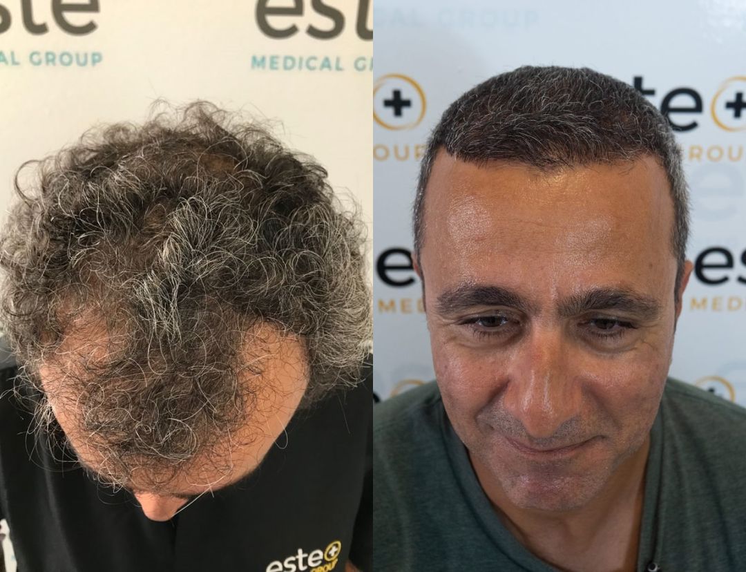 Hair Transplant Turkey | Best Hair Transplant Turkey Award Winner