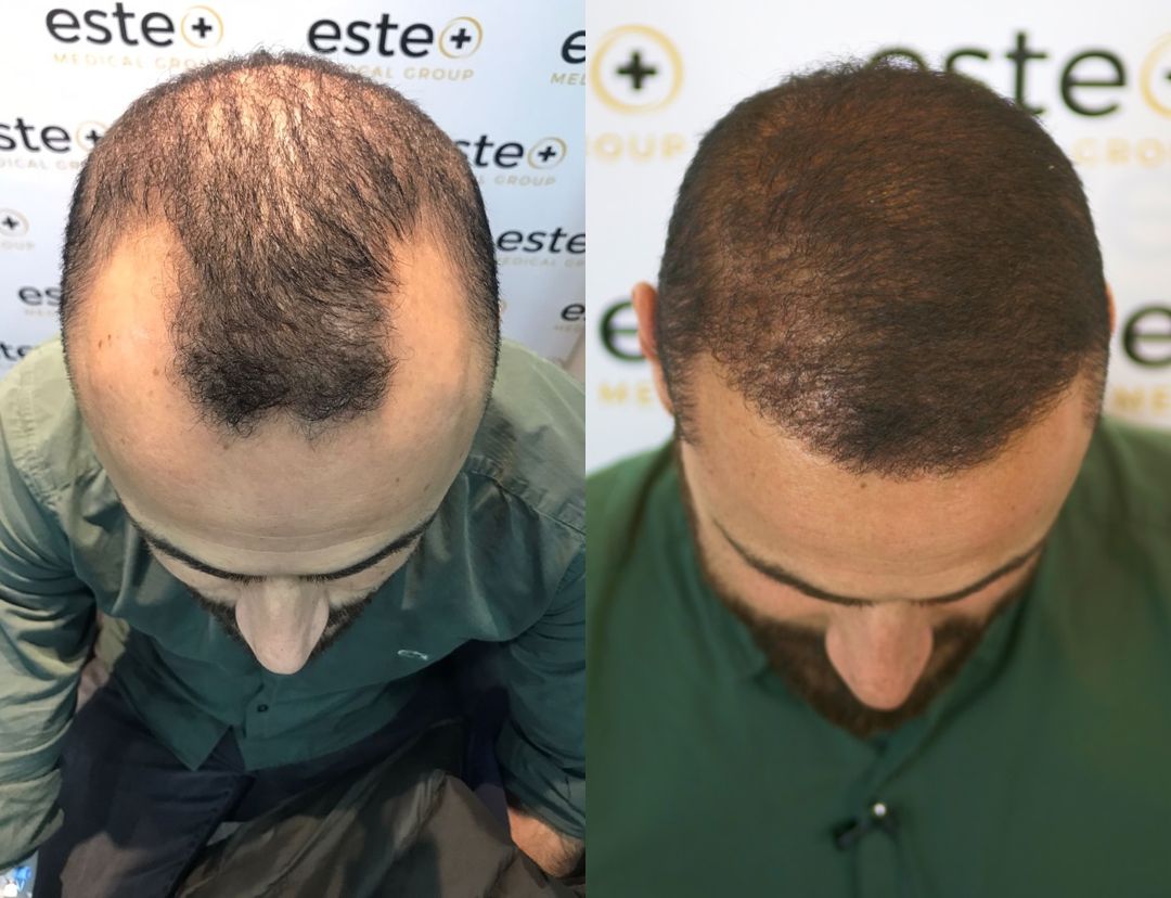 Hair Transplant Turkey | Best Hair Transplant Turkey Award Winner