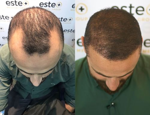 Hair Transplant Turkey | Best Hair Transplant Turkey Award Winner
