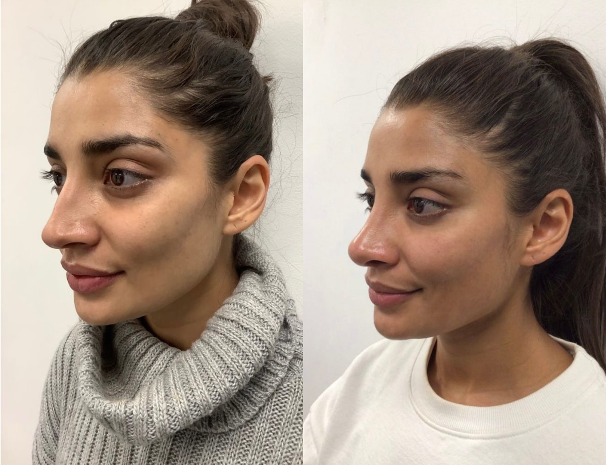 Rhinoplasty Surgery Turkey | Nose Surgery UK – Este