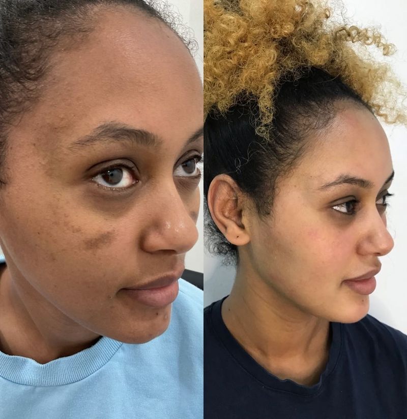 Skin Pigmentation Treatment | Laser Pigmentation | Cosmelan Peel