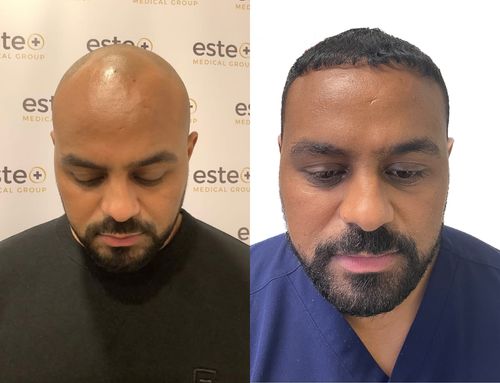 Hair Transplant Turkey | Best Hair Transplant Turkey Award Winner