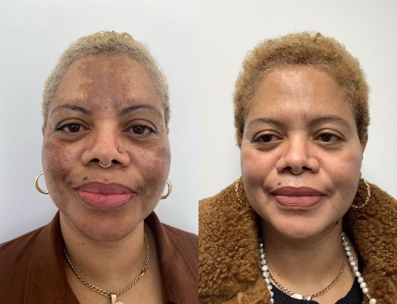 Skin Pigmentation Treatment | Laser Pigmentation | Cosmelan Peel