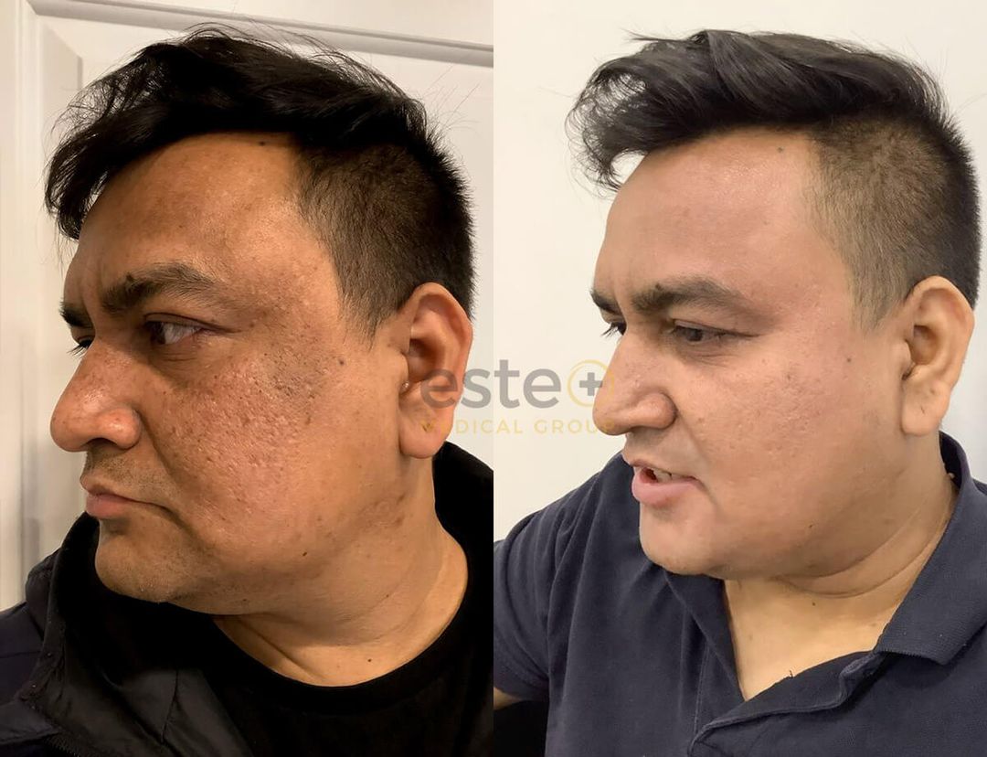 Cosmelan Pigmentation Peel | Este Medical Group