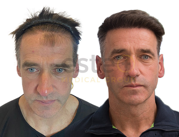 Hair Loss for Men | Male Hair Loss Turkey