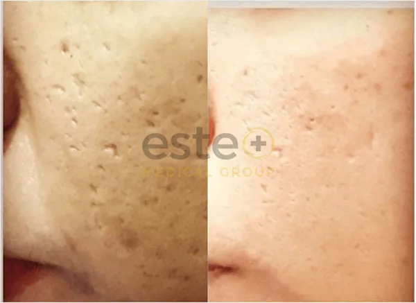 Chemical Peels | Chemical Peel Treatment | Dead Skin