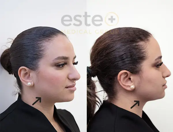 Fat Dissolving Injections Manchester | Lemon Bottle Manchester